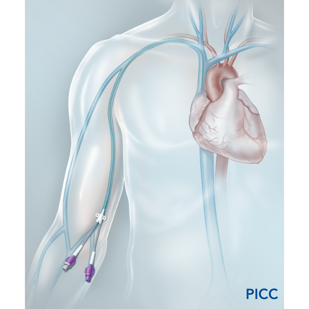 Information für Patienten mit Katheter | MCM MEDSYS